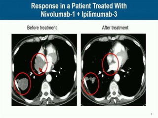 Phase I/II study of nivolumab with or without ipilimumab for treatment of recurrent small cell ...
