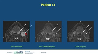 E1308: Reduced-dose IMRT in human papilloma virus (HPV)-associated resectable oropharyngeal ...